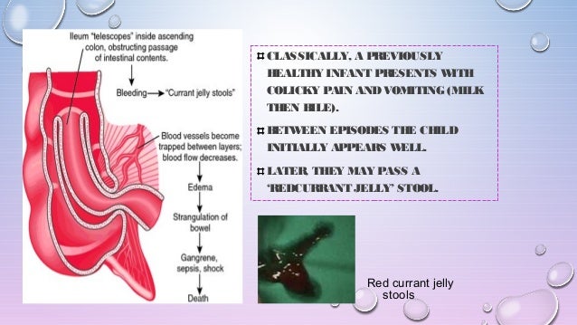 red currant jelly stool picture