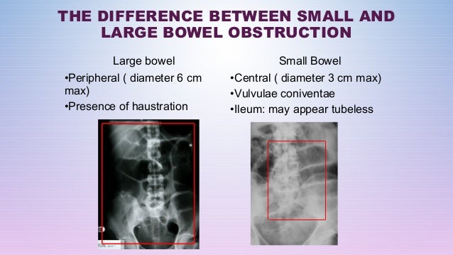 Intestinal obstruction
