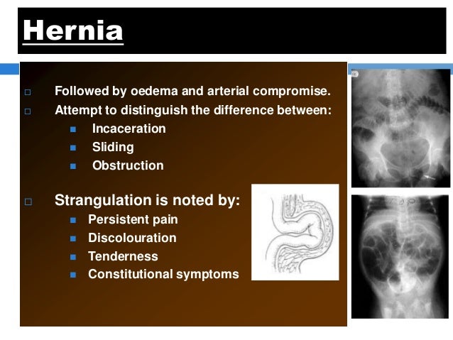 Intestinal obstruction