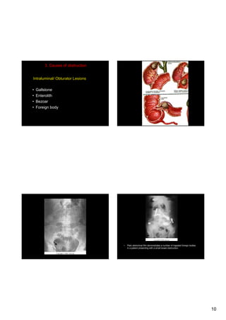 Intestinal obstruction | PDF