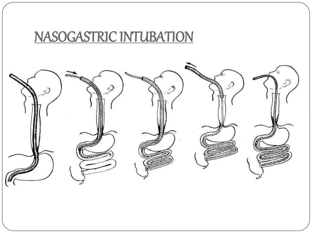 Surgical Management of Intestinal Obstruction