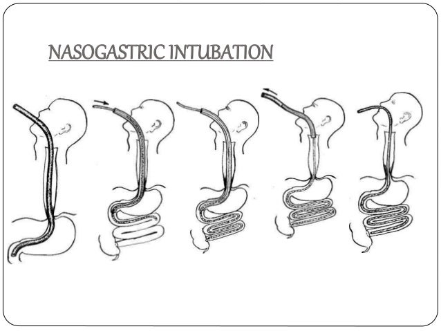 Surgical Management of Intestinal Obstruction