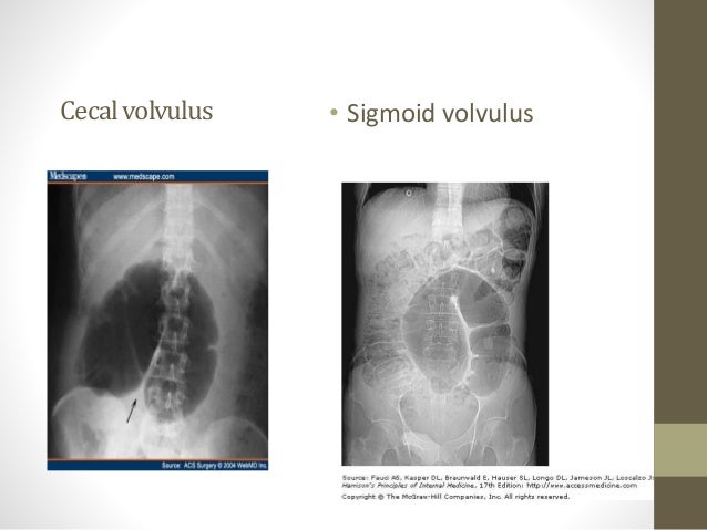 Intestinal obstruction by Dr.Usman Haqqani