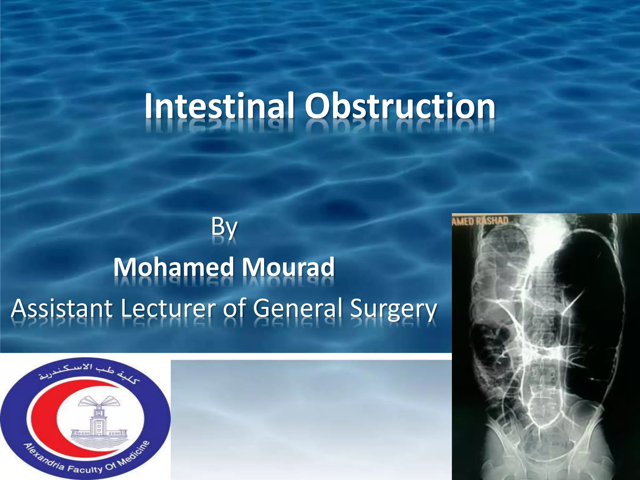 Intestinal obstruction | PPTX