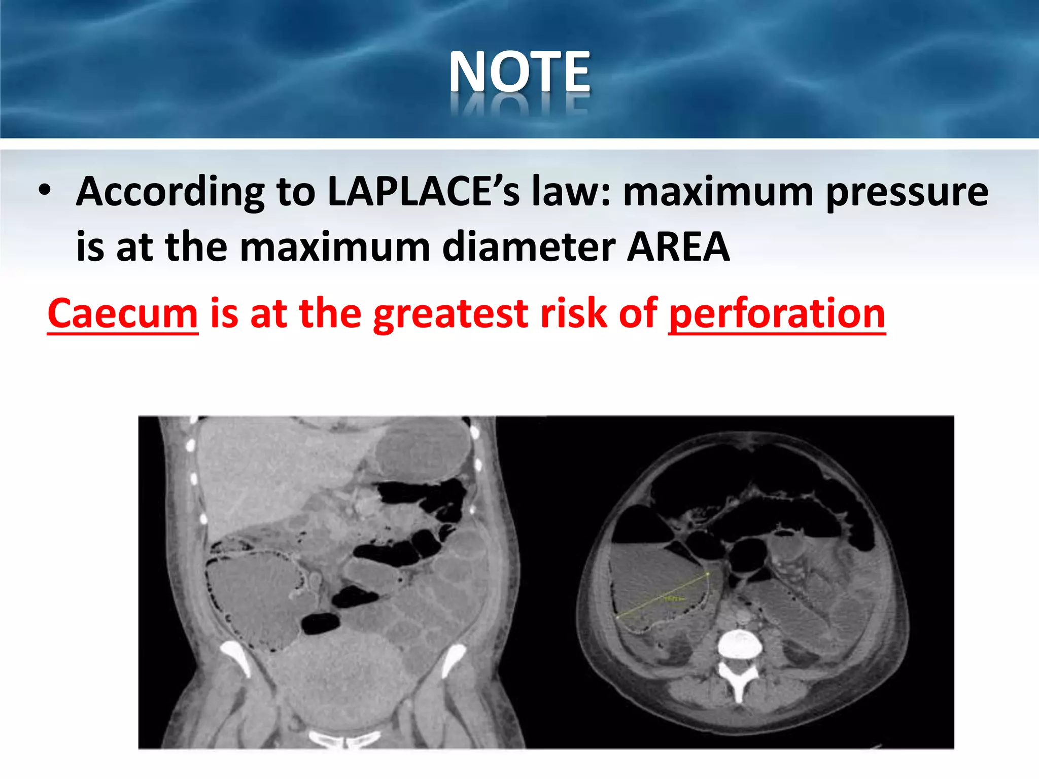 Intestinal obstruction | PPTX