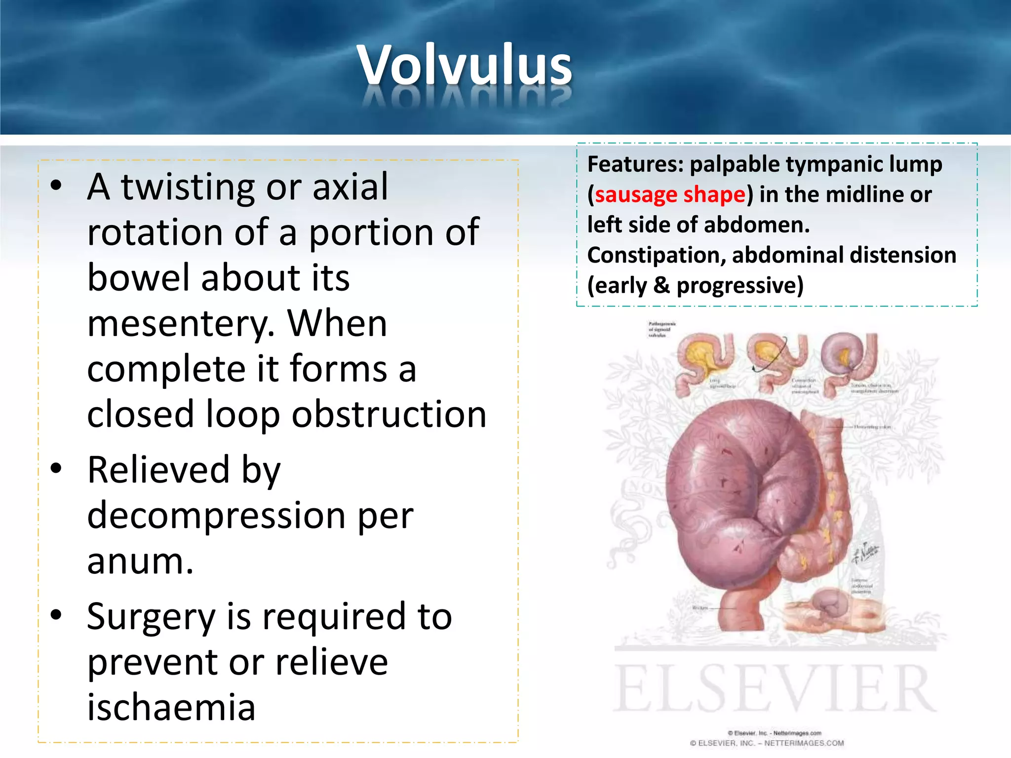 Intestinal obstruction | PPTX
