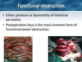 Intestinal obstruction | PPTX