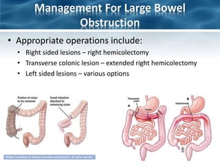 Intestinal obstruction | PPT