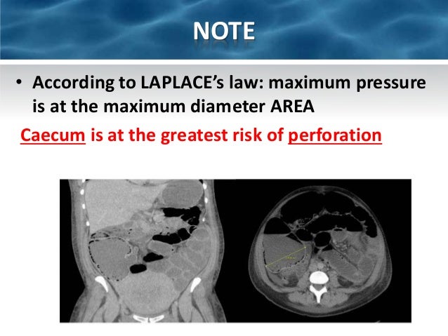 Intestinal obstruction