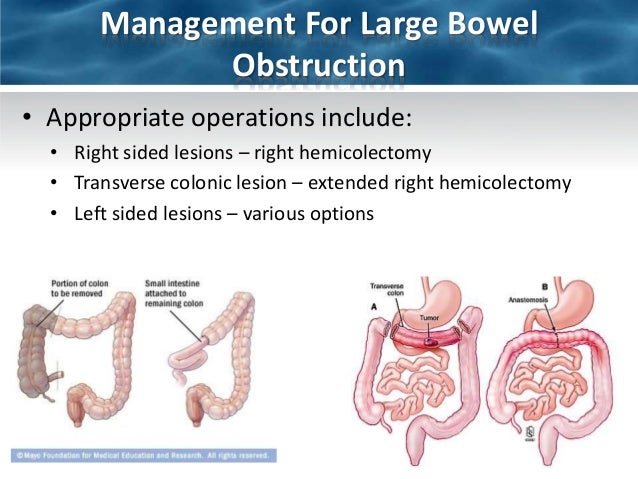 Intestinal obstruction