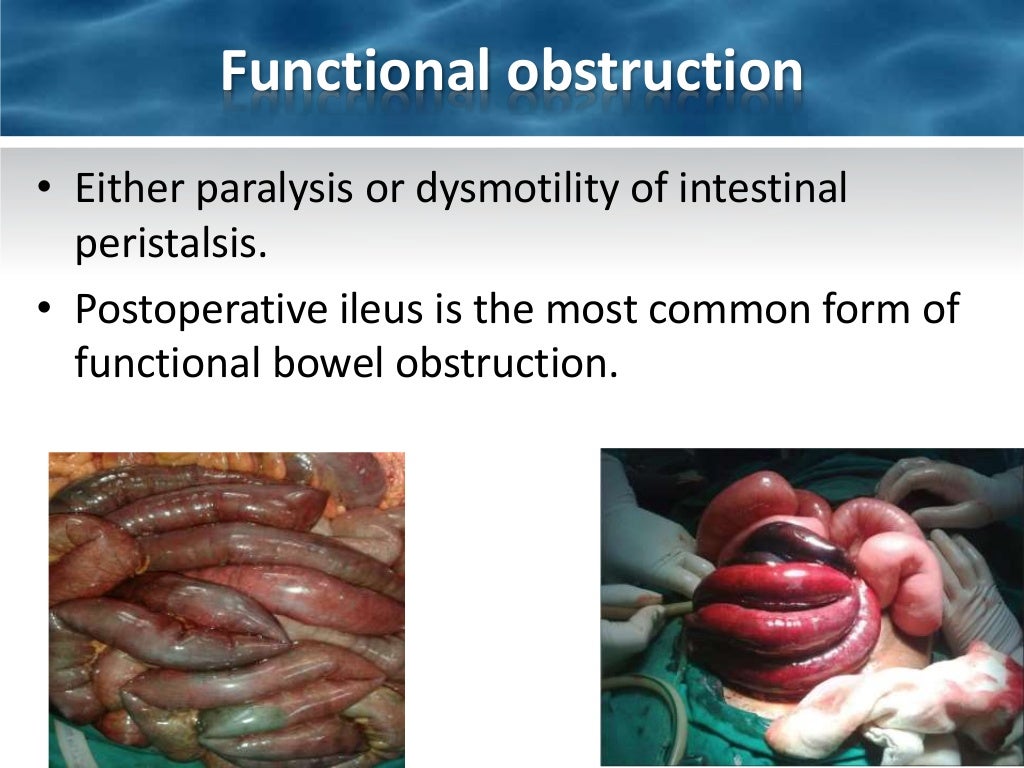 Intestinal obstruction