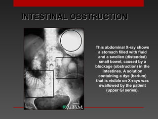 INTESTINAL OBSTRUCTION | PPT