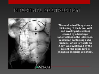 INTESTINAL OBSTRUCTION | PPT