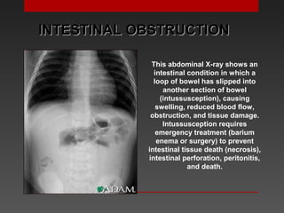 INTESTINAL OBSTRUCTION | PPT