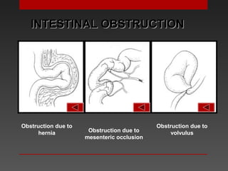 INTESTINAL OBSTRUCTION | PPT