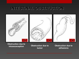 INTESTINAL OBSTRUCTION | PPT