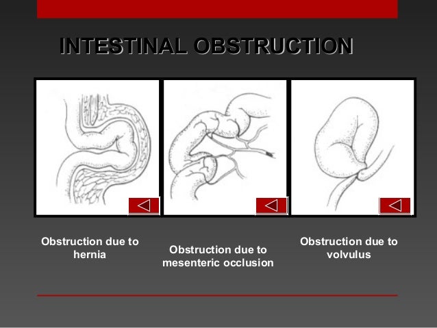 INTESTINAL OBSTRUCTION