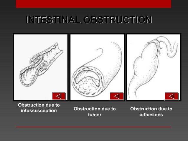 INTESTINAL OBSTRUCTION
