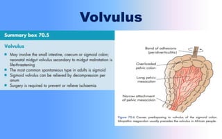 Intestinal obstruction | PPTX