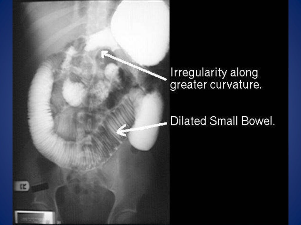 Intestinal obstruction