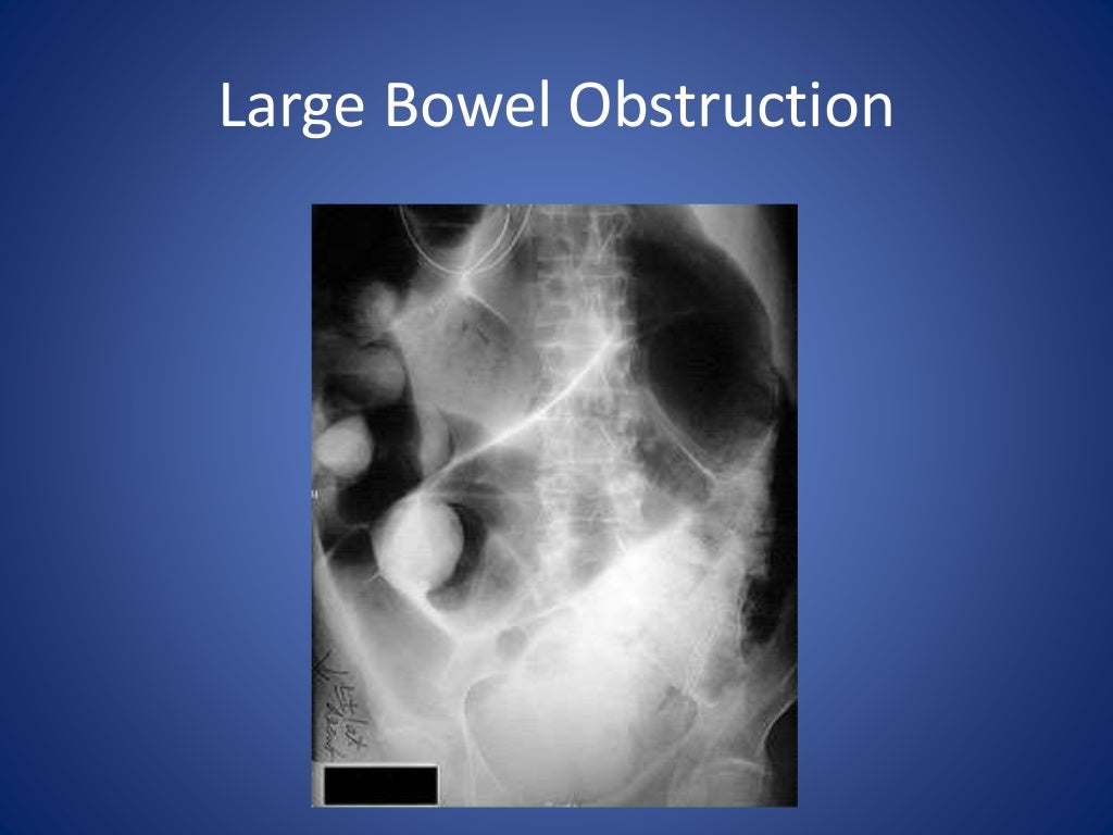 Intestinal obstruction