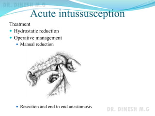 Intestinal Obstruction | PPTX