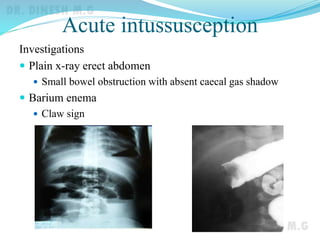 Intussusception Claw Sign