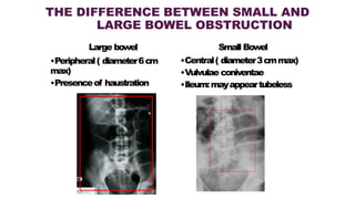 Intestinal obstruction | PPTX
