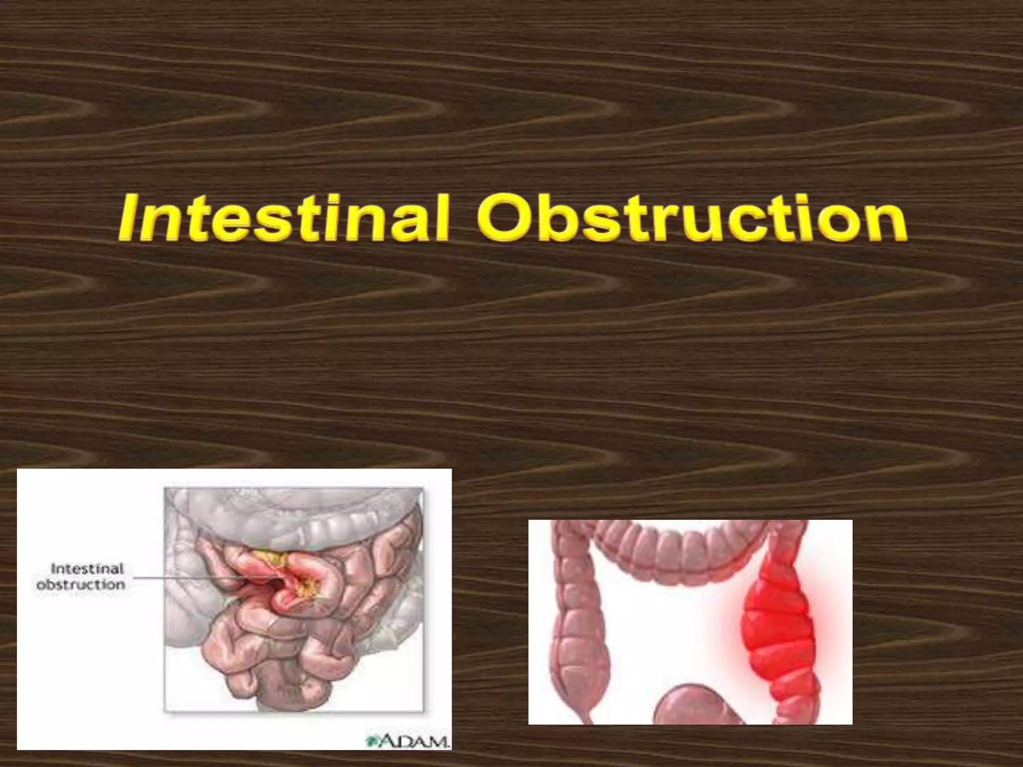Intestinal obstruction | PPTX
