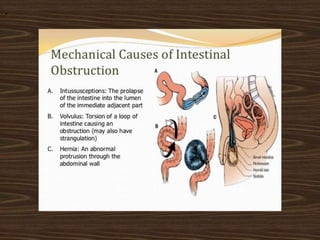 Intestinal obstruction | PPTX