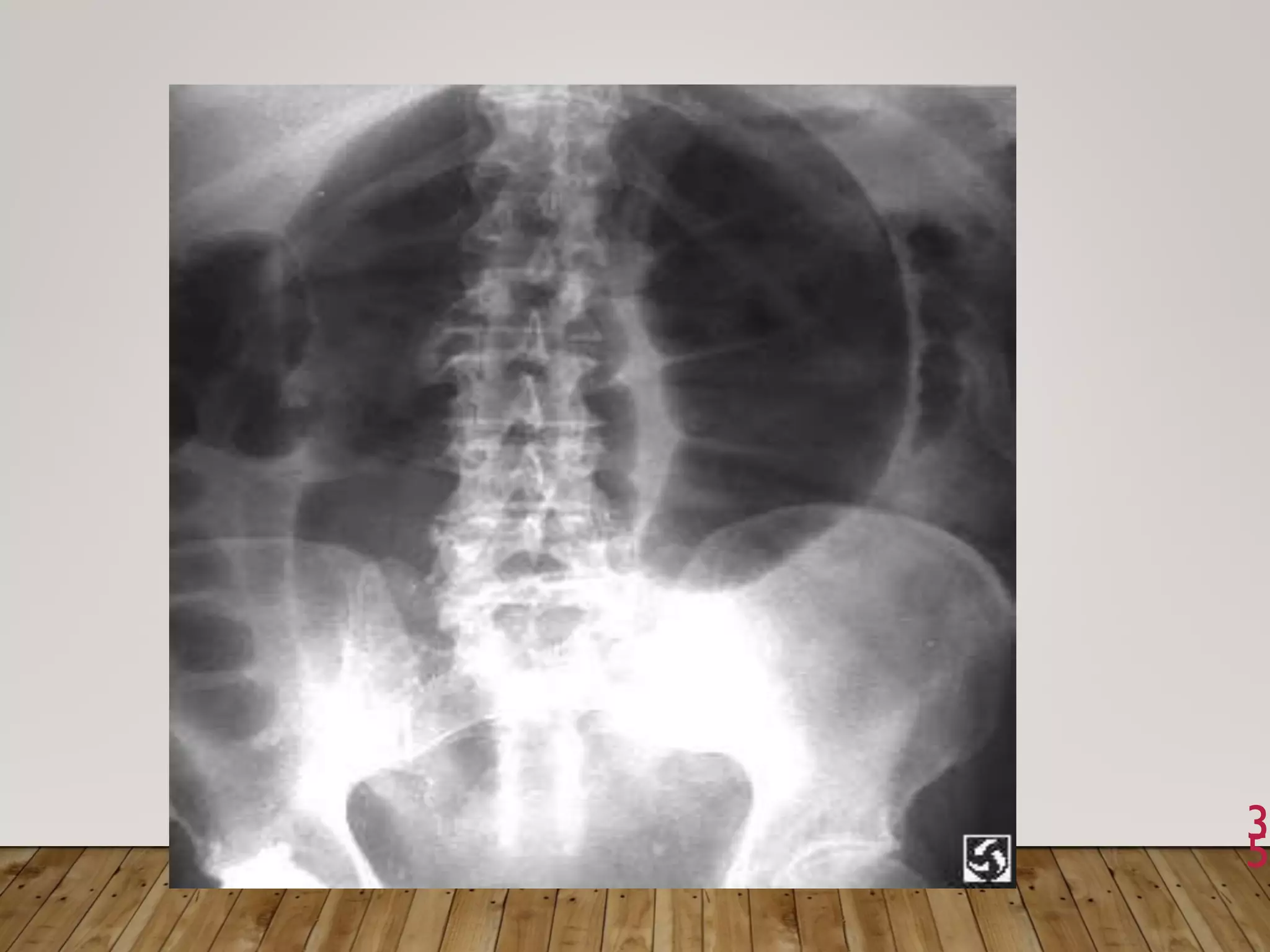 Intestinal obstruction | PDF
