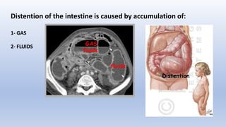 Intestinal obstruction by Dr. Nitin Alapure | PPTX