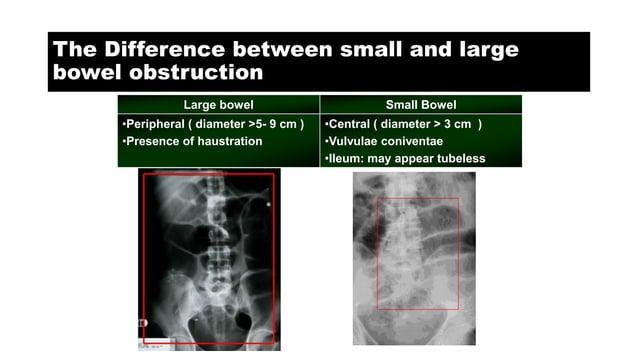 Intestinal obstruction, Ileus, and volvulus | PPTX | Digestive ...