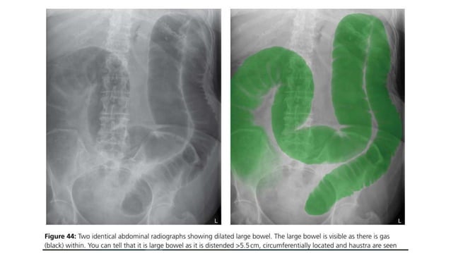 Intestinal obstruction, Ileus, and volvulus | PPTX | Digestive ...