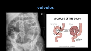Intestinal obstruction | PPTX