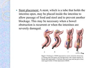 Intestinal obstruction | PPTX