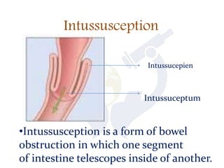 Intestinal obstruction Pathology | PPT