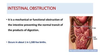 INTESTINAL OBSTRUCTION | PPT
