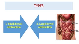 INTESTINAL OBSTRUCTION | PPT