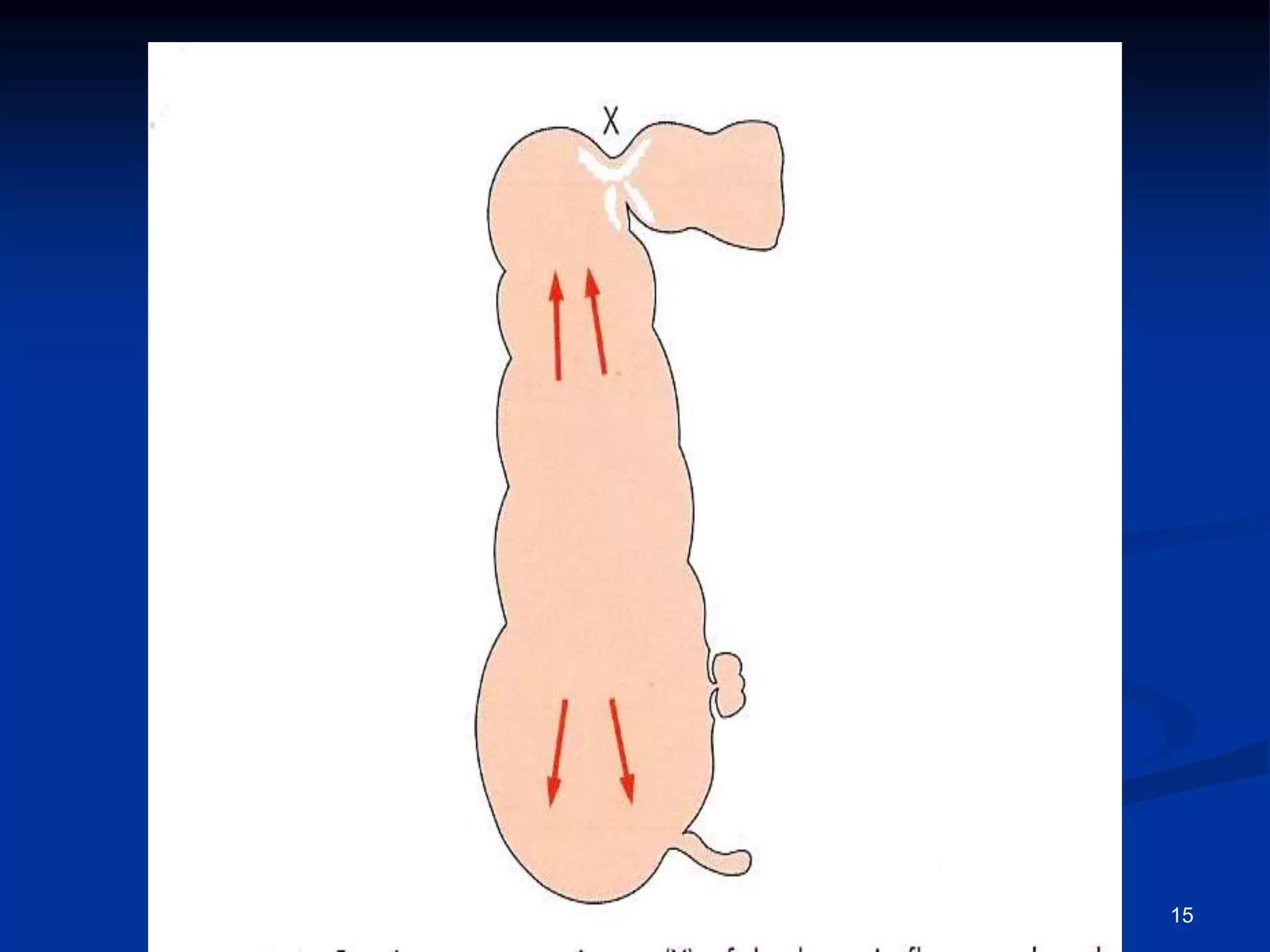 Intestinal_Obstruction.ppt