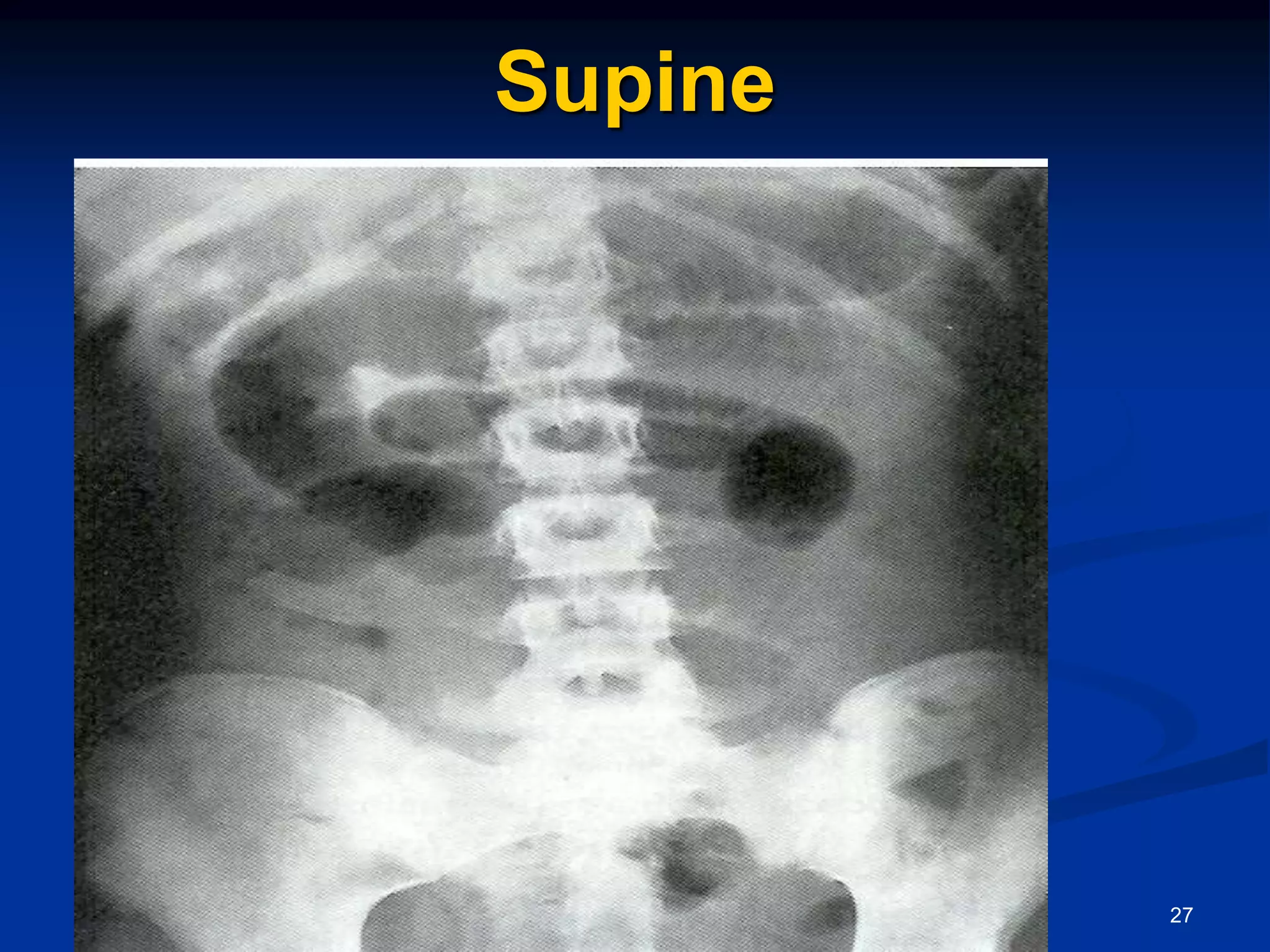 Intestinal_Obstruction.ppt