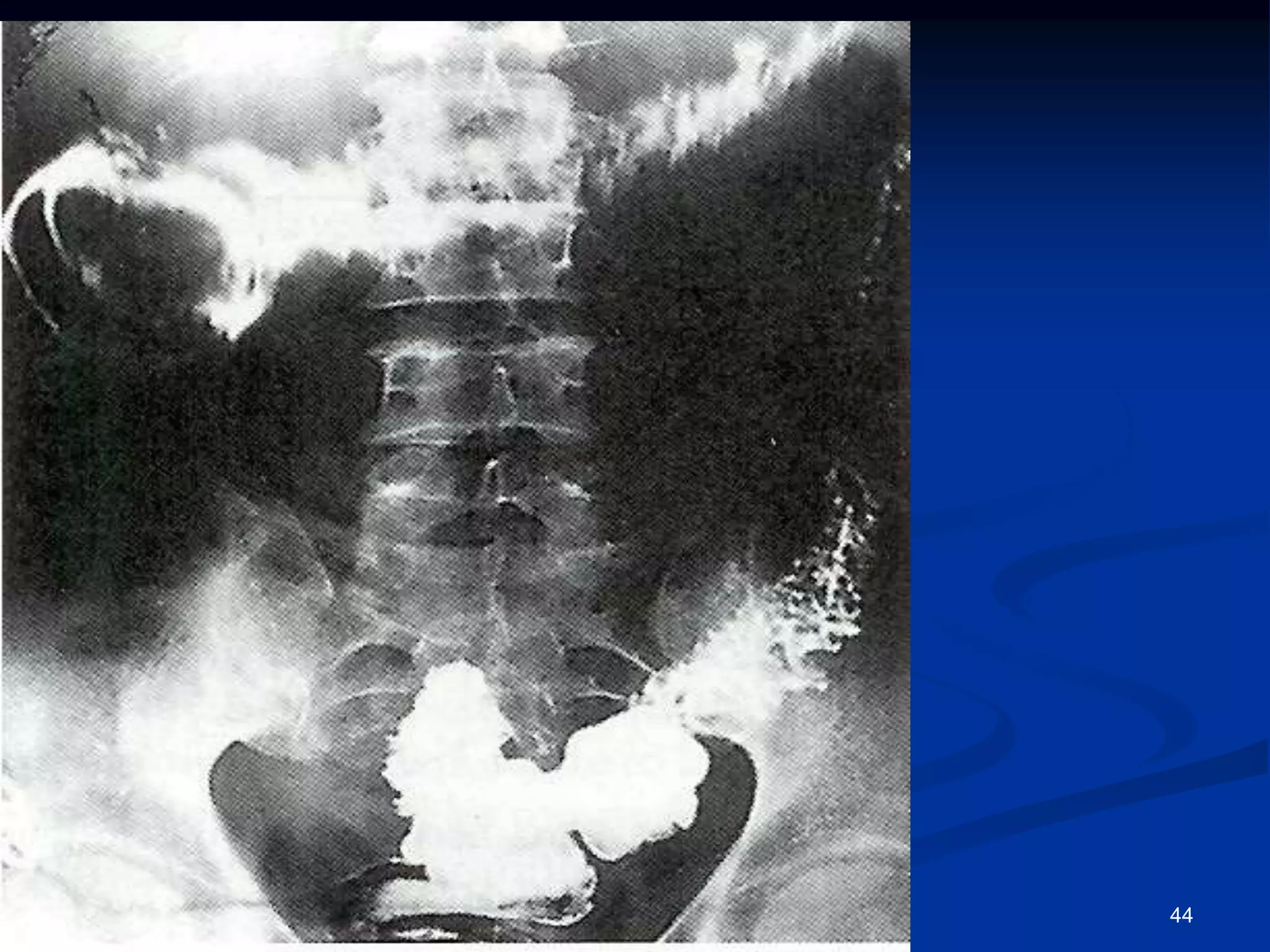 Intestinal_Obstruction.ppt