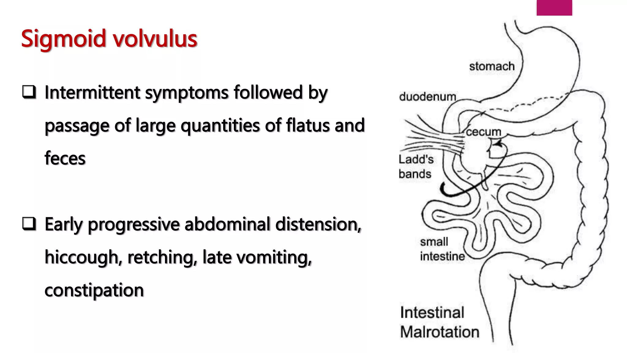 intestinal obstruction.pptx