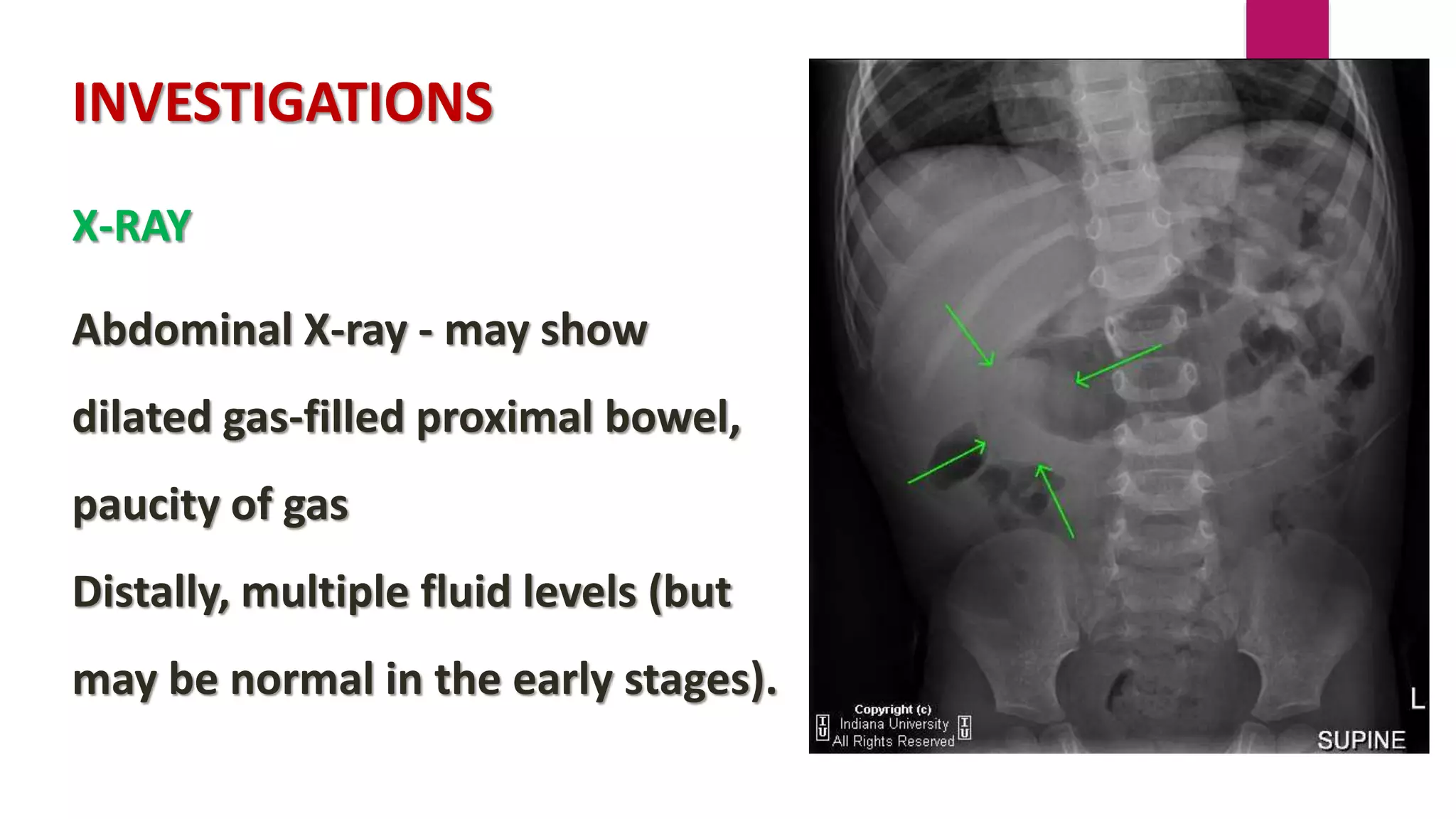intestinal obstruction.pptx