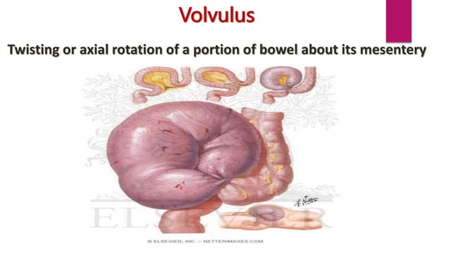 intestinal obstruction.pptx