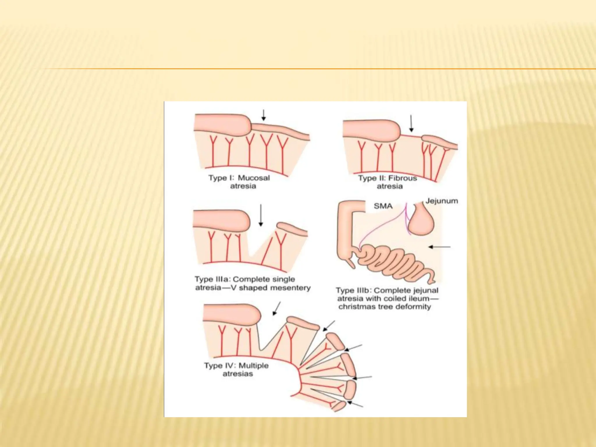 intestinal obstruction.pptx