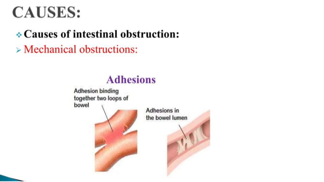INTESTINAL OBSTRUCTION, intestinal disorder.pptx