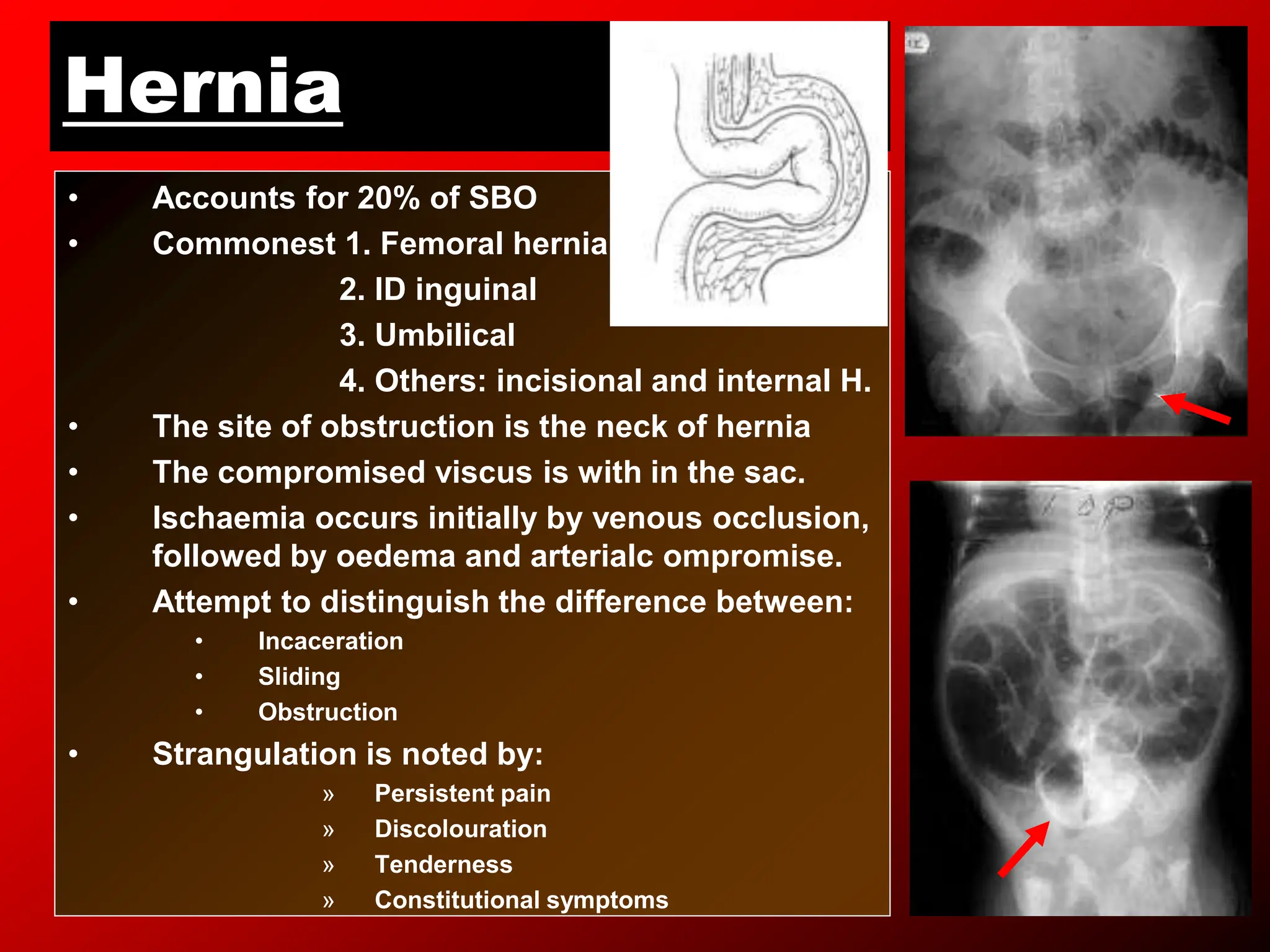 Intestinal Obstruction presentation for students.ppt