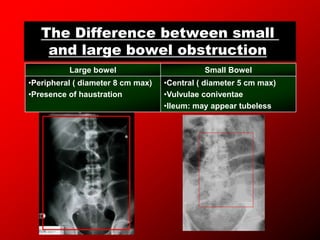 Intestinal Obstruction presentation for students.ppt