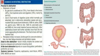 Intestinal Obstruction - Types, C/F & Management | PDF